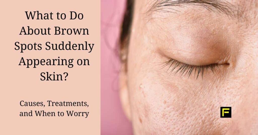 Brown Spots Suddenly Appearing On Skin: Causes, Treatments, And When To ...
