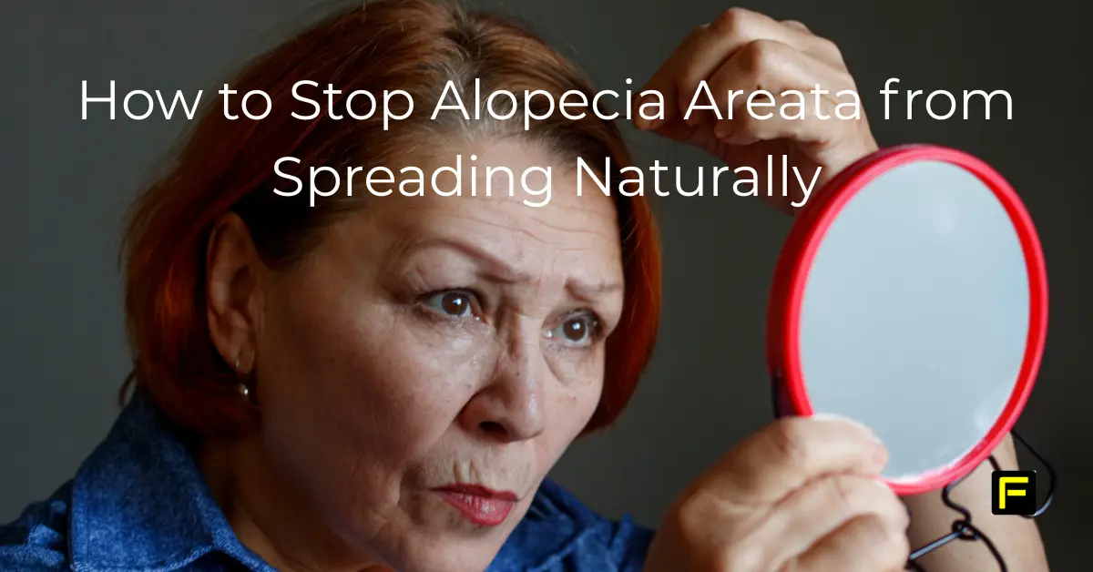 How To Stop Alopecia Areata From Spreading Naturally: What Women Over ...